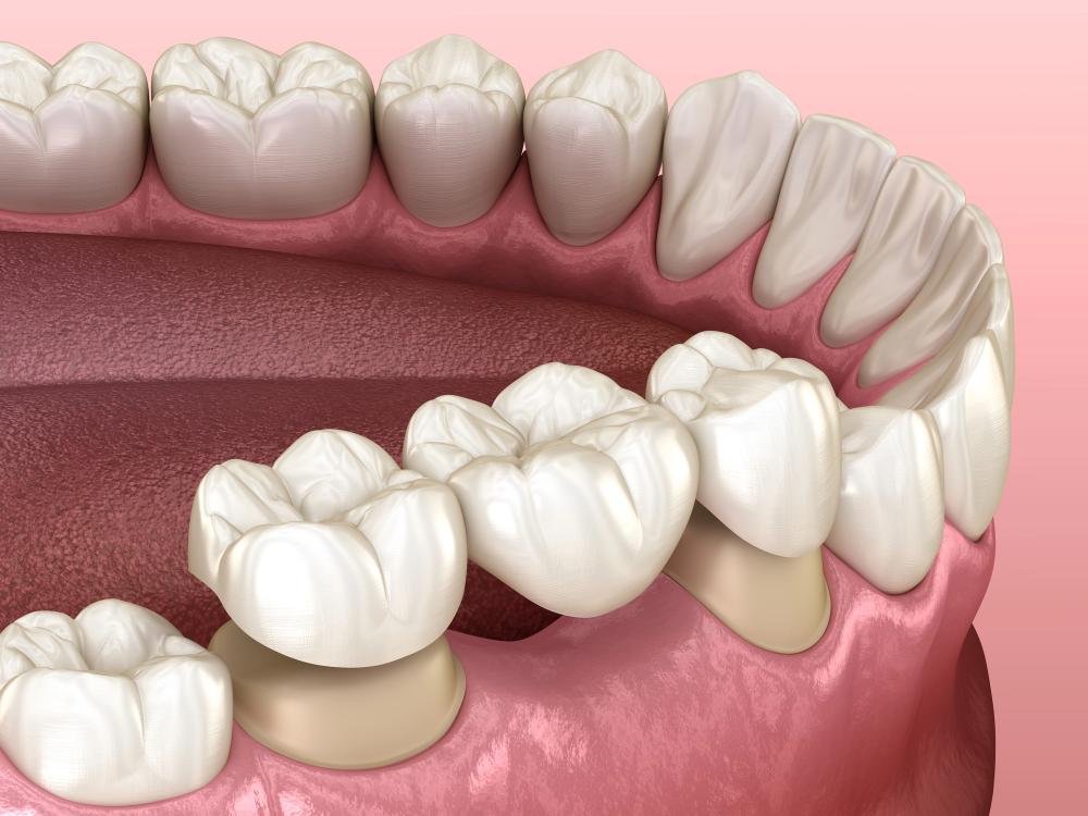 Dentures Vs. Bridges: Key Differences Explained