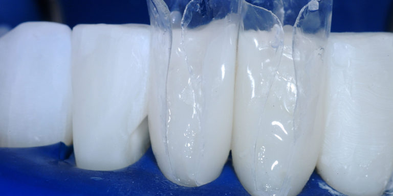 How Bioclear Matrices Can Be Used To Seal Diastemas | Dr. Alex Midtown ...