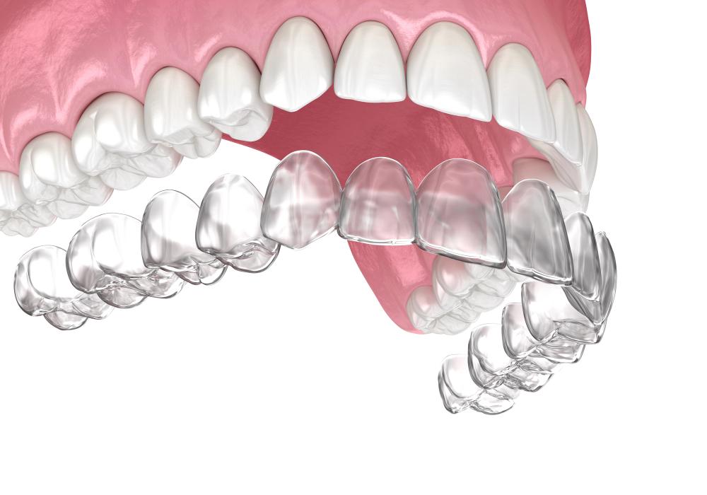 Should You Use A Retainer Or Invisalign?