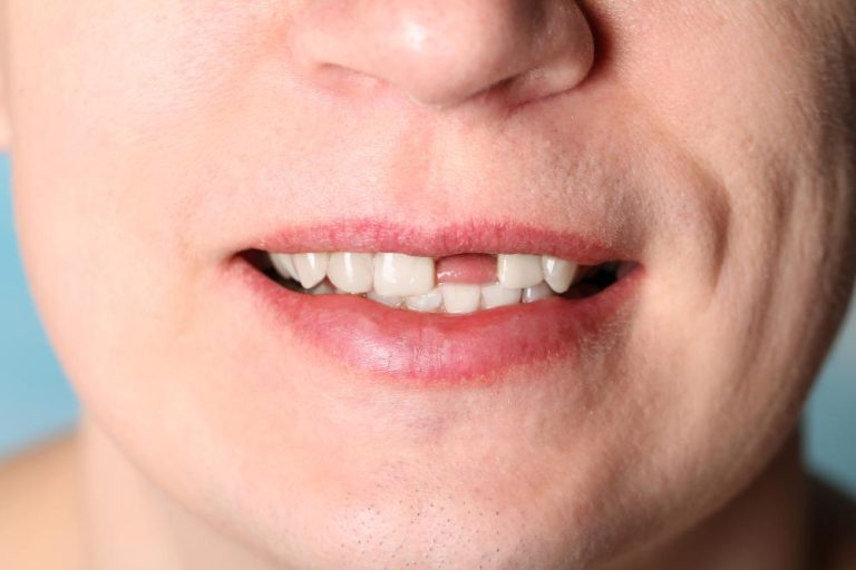 Tooth Avulsion Explained: Causes, Symptoms, And Prevention