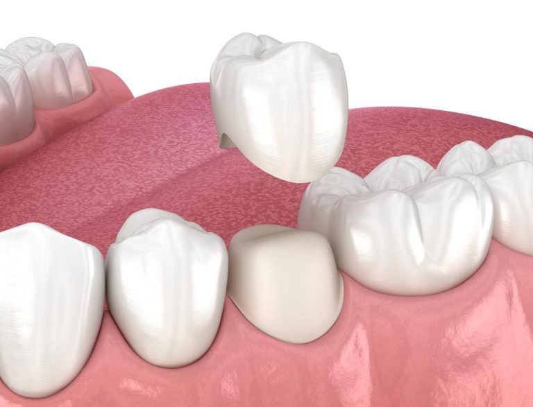 What Are Crowns For Teeth? 10 Things You Need To Know