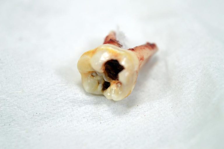 What Are The Signs Of Wisdom Teeth Infection?