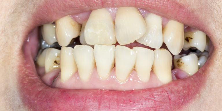 What’s The Best Solution for Crooked Teeth? | Dr. Alex Midtown NYC ...