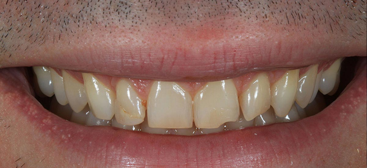 Beautiful Porcelain Veneers | Cosmetic Dentist Dr. Alex Midtown NYC